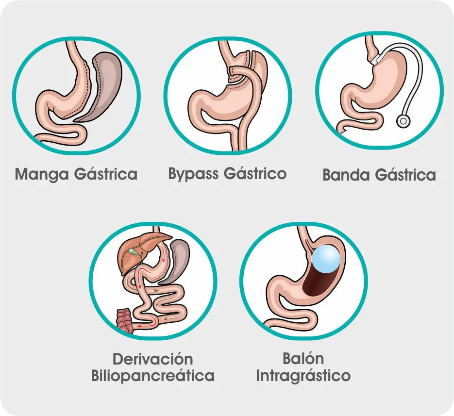 Cirugia Bariatrica